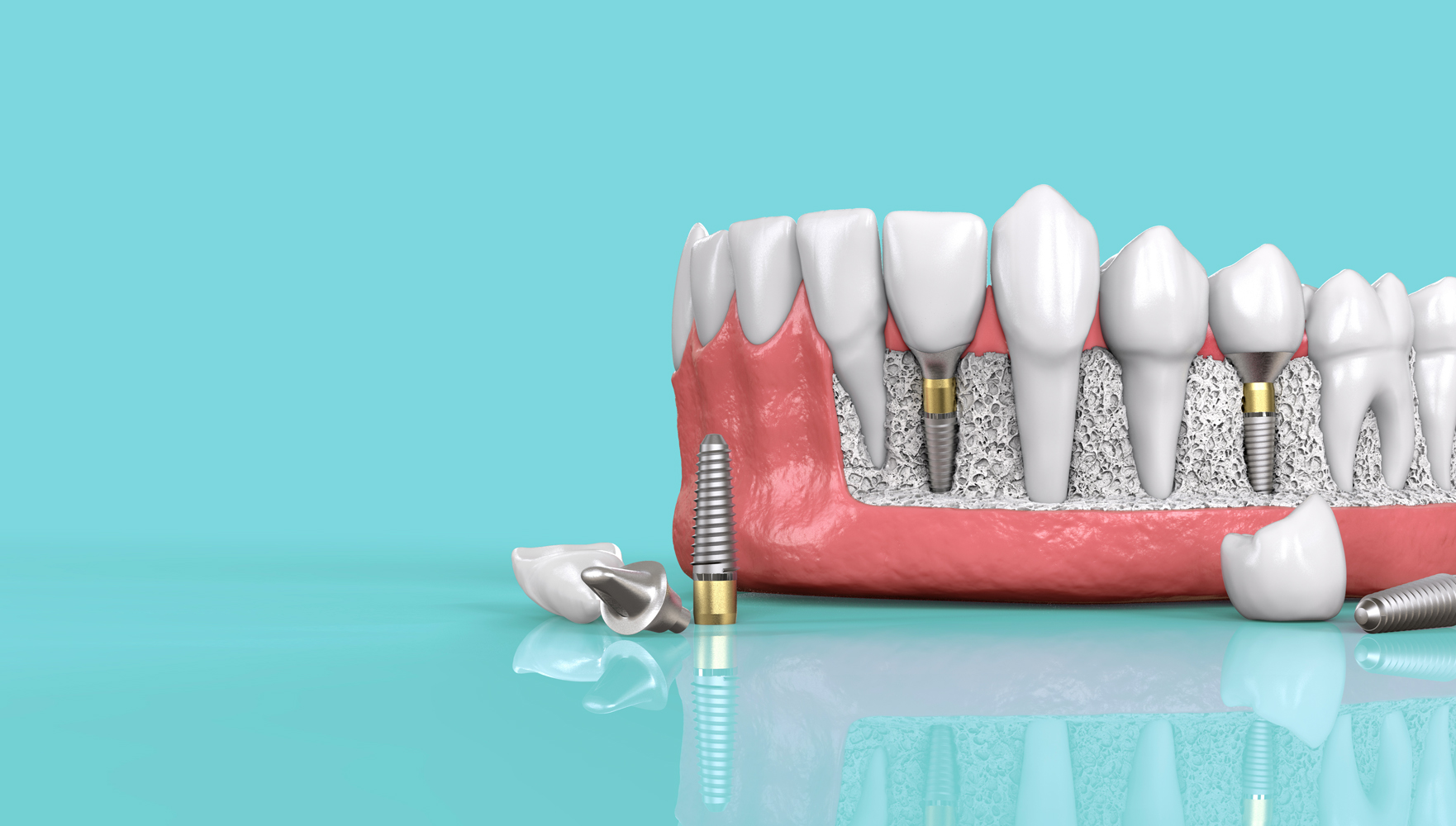 Zubni implantati: Sve što trebate znati prije ugradnje | Zdravarica